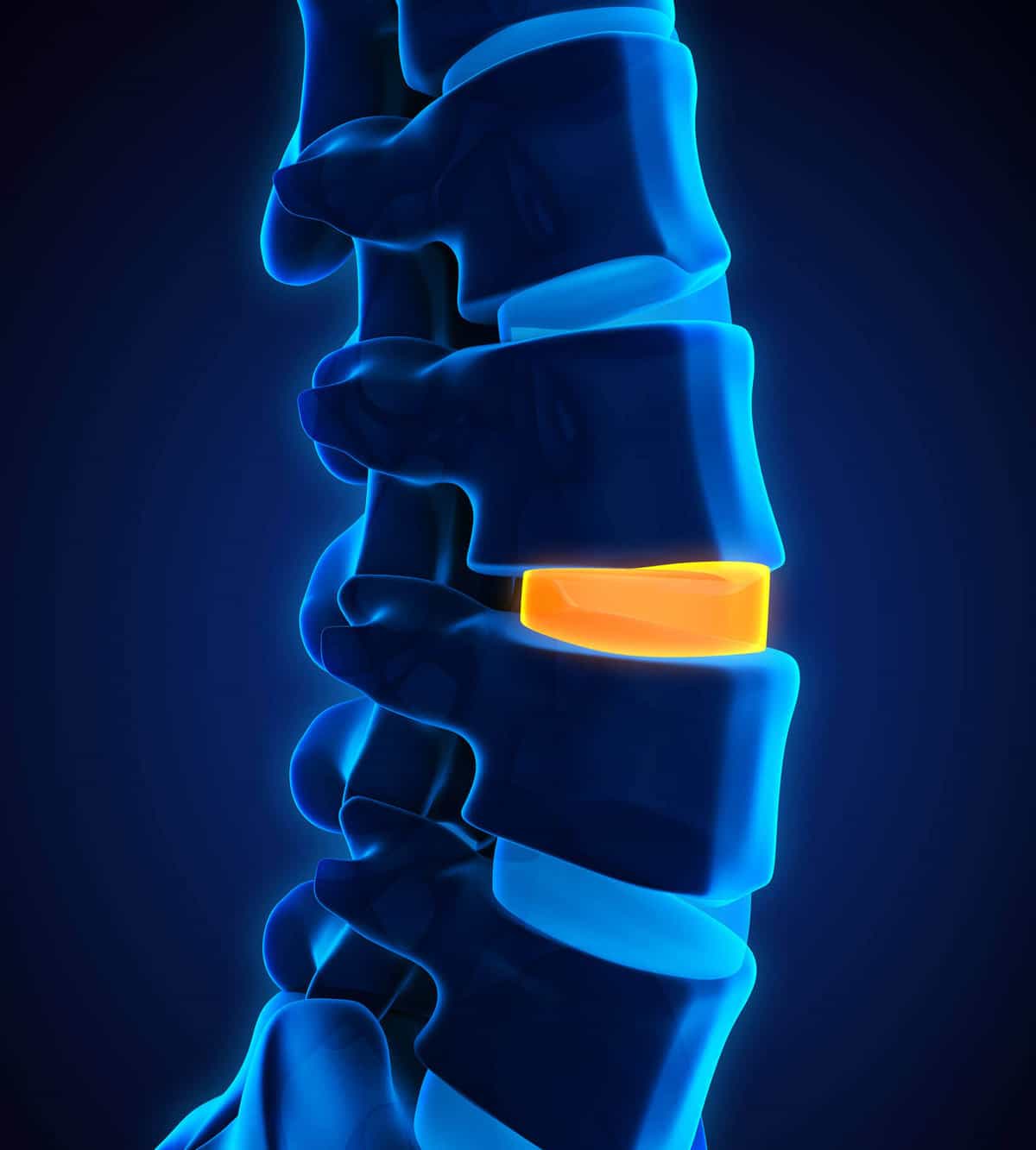 Back in Motion with Stem Cell Therapy for Degenerative Disc Disease ...